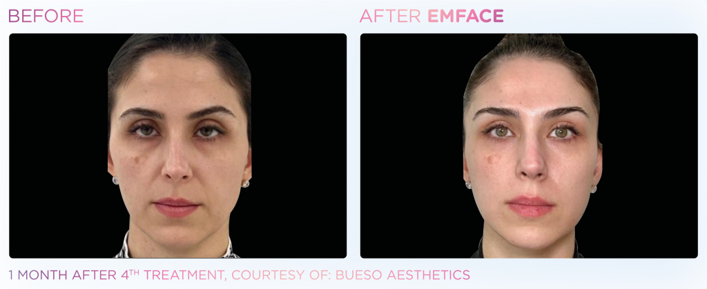 EMface: The Future of Non-Invasive Facial Sculpting | RSVP Beauty Clinic